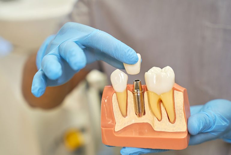 Dental Implants Explained: A Simple Guide To The Procedure And Care ...